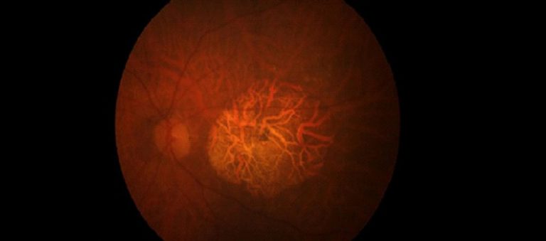 Degeneração macular relacionada à idade (DMRI) - Promácula - Dr. Nelson ...